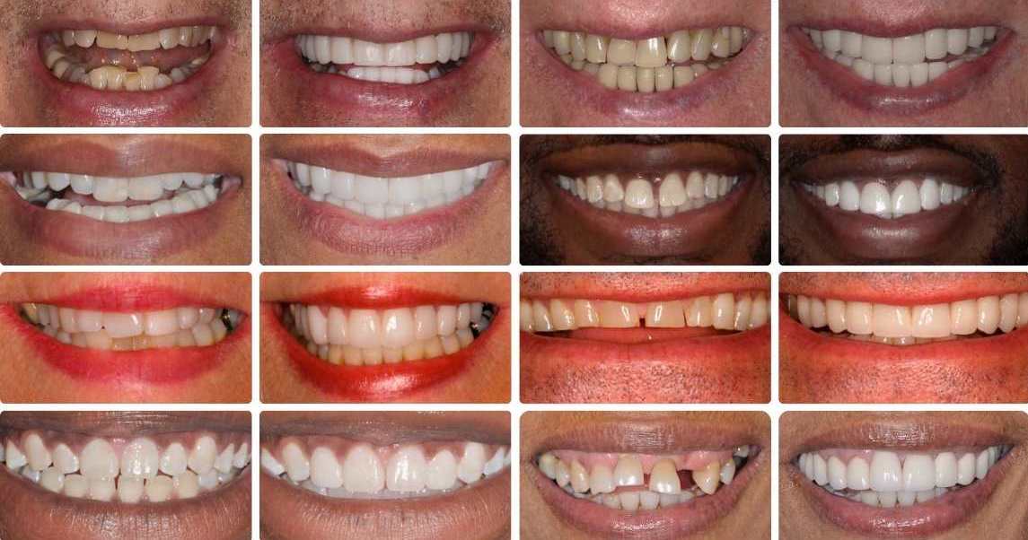 Before and After Gallery | Atlanta Smiles | Real Patient Results